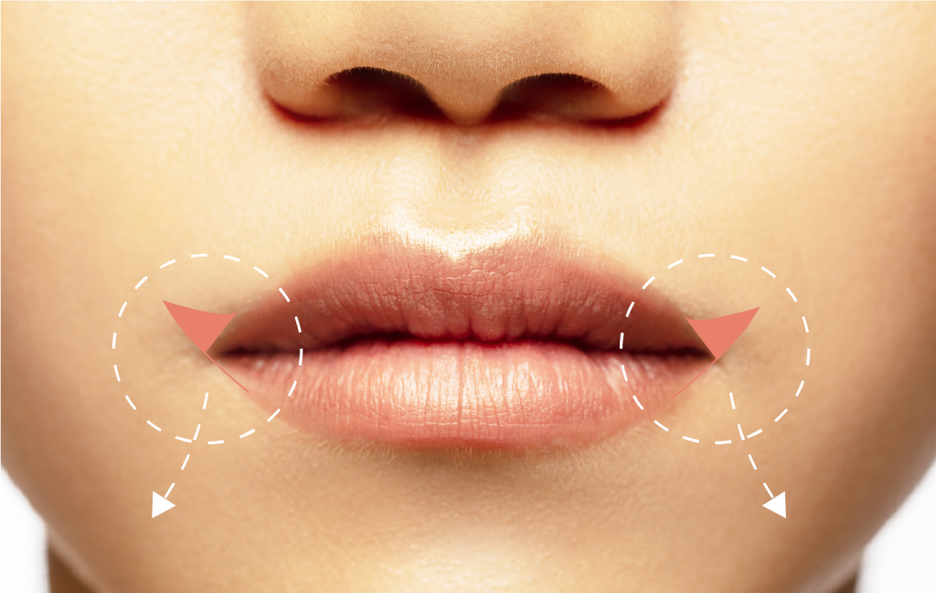 微笑線手術 - 雅里絲醫美診所